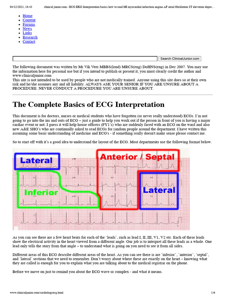 ECG EKG Interpretation Basics How To Read MI Myocardial Infarction ...