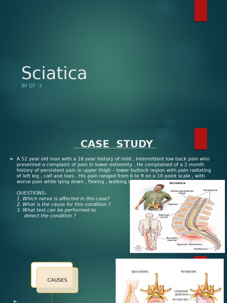 Sciatica [Autosaved] | PDF | Clinical Medicine | Musculoskeletal Disorders