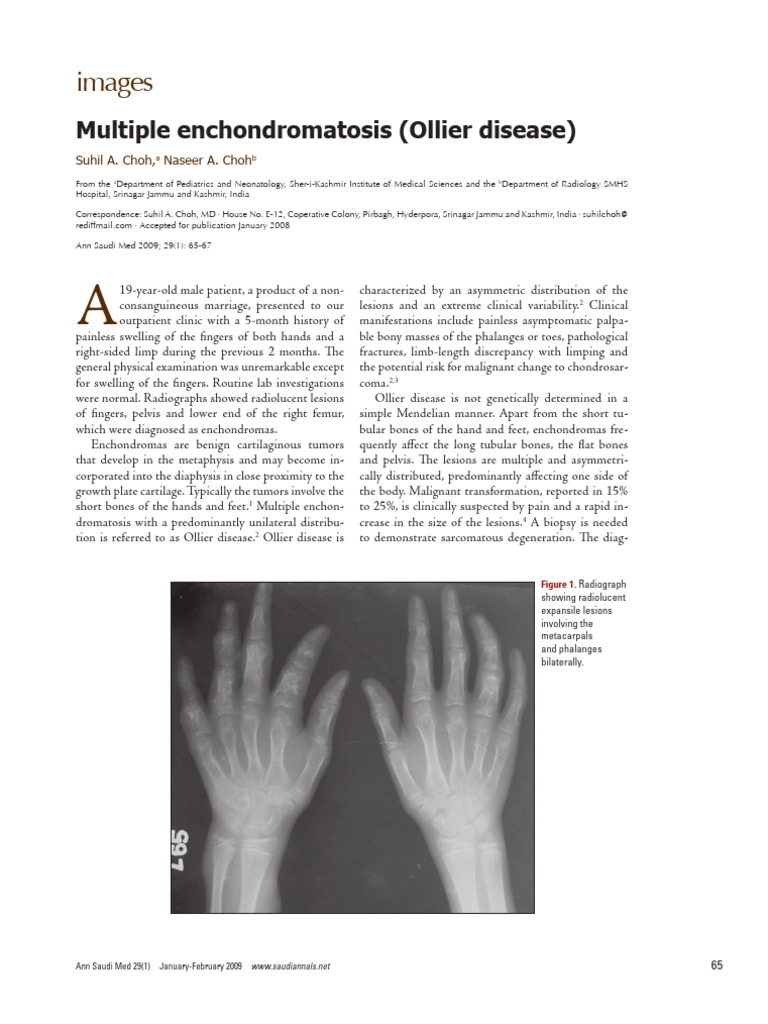 Choh Choh 2009 Multiple Enchondromatosis (Ollier Disease) | PDF ...