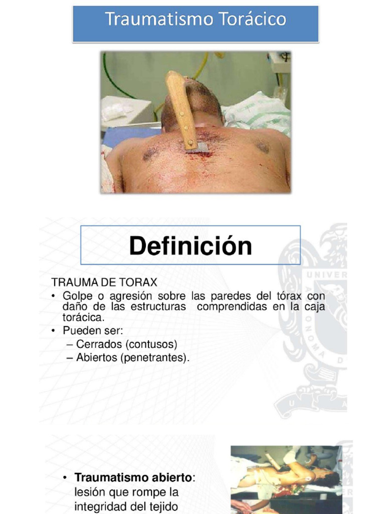 Trauma Torácico | PDF