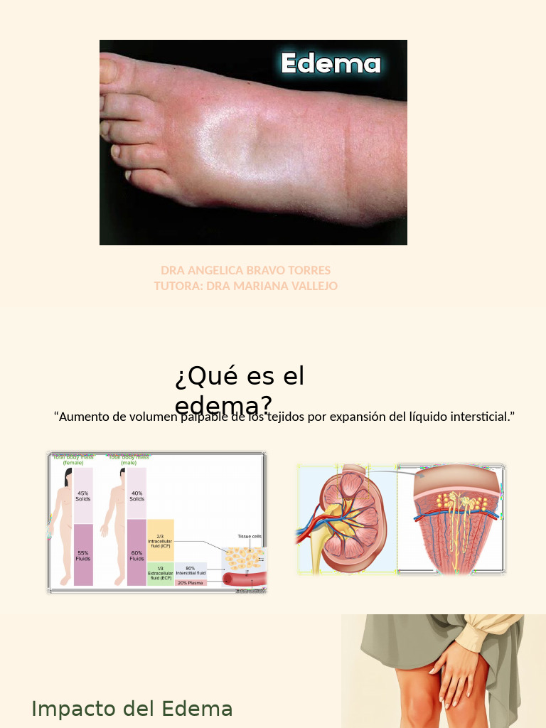 Exposicion de Edema | PDF | Edema | Especialidades Medicas