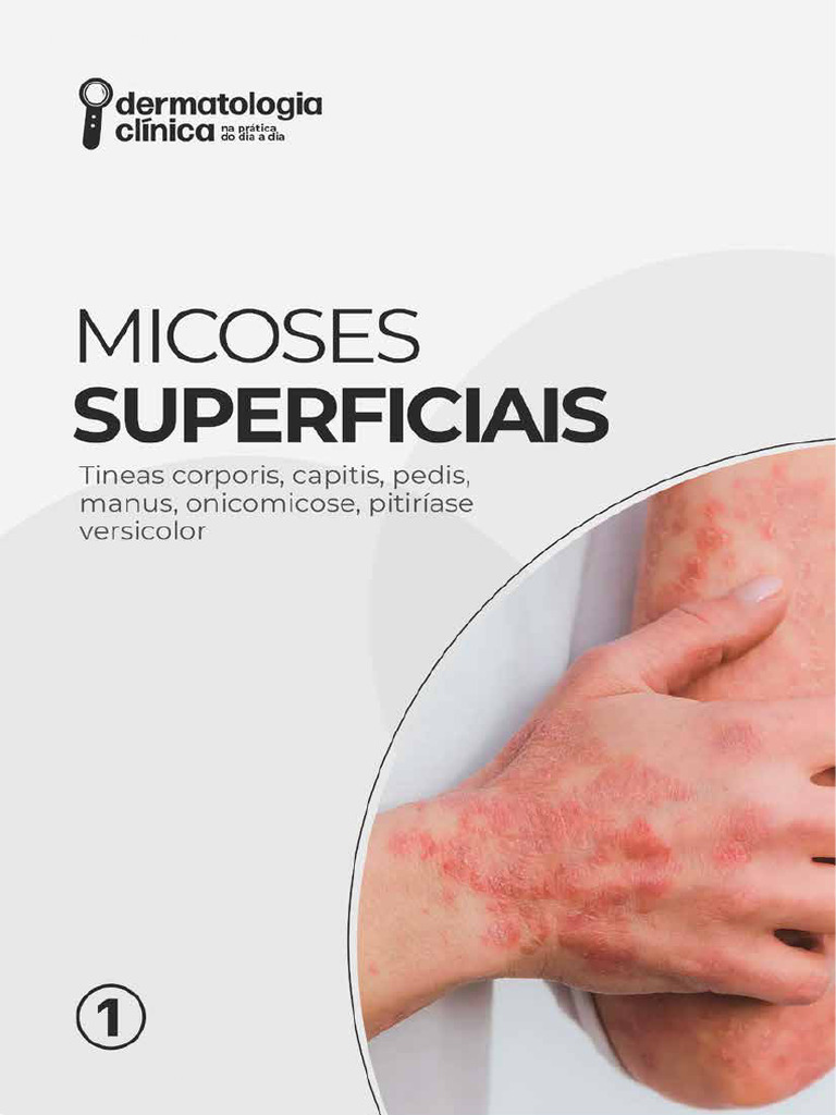 Corrigida Micoses Superficiais | PDF | Cabelo