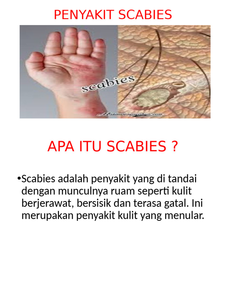 Scabies | PDF
