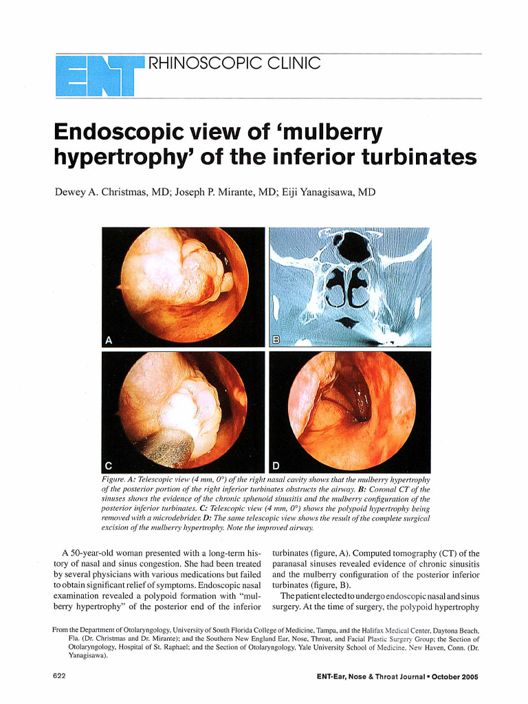 Endoscopic Surgery for Mulberry Hypertrophy | PDF | Otorhinolaryngology ...
