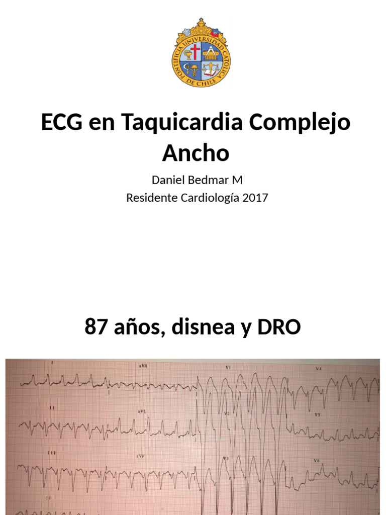 Taquicardia Complejo Ancho | PDF | Electrocardiografia | Causas de la ...