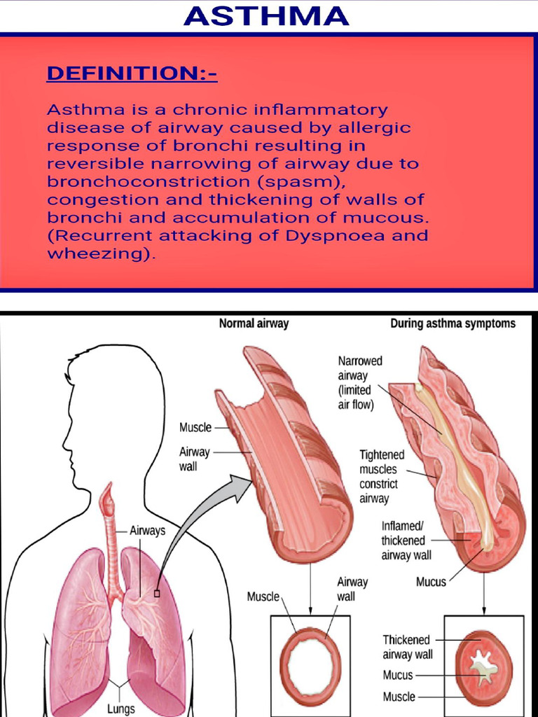 Asthma | PDF | Asthma | Respiratory Tract