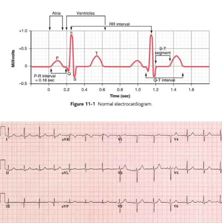 ECG (1) | PDF