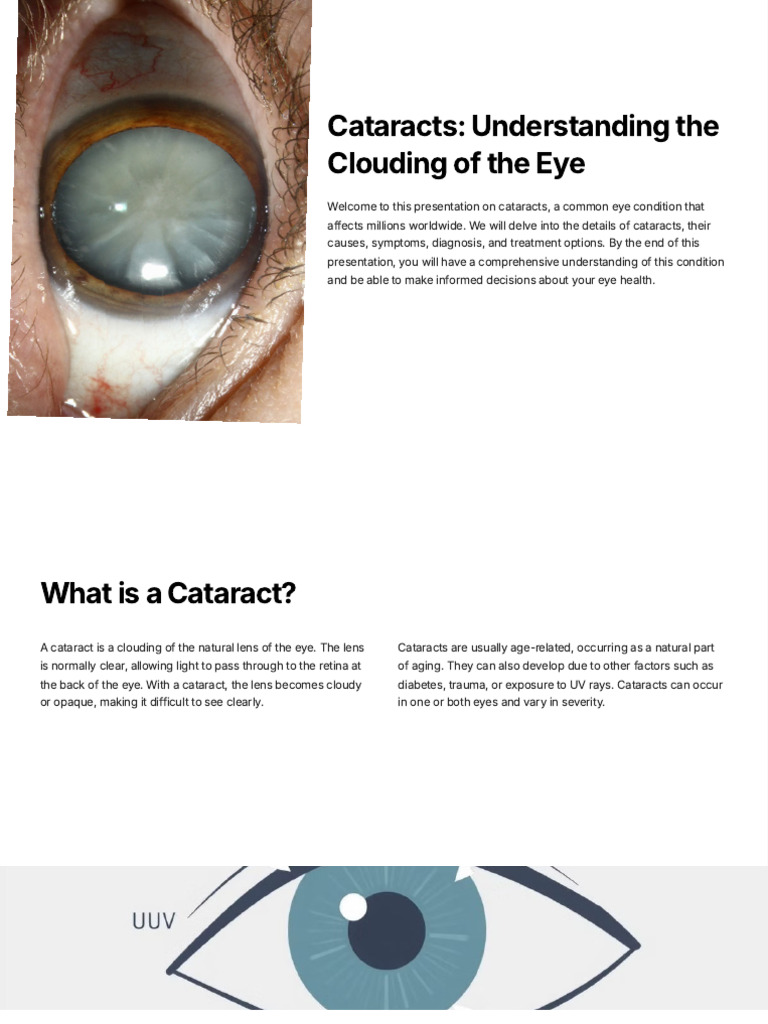 Cataracts Understanding The Clouding of The Eye | PDF | Cataract | Eye