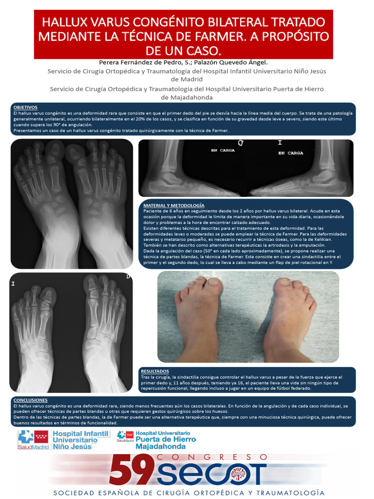 Haluxx Varus Congenito | PDF | Dedo del pie | Cirugía