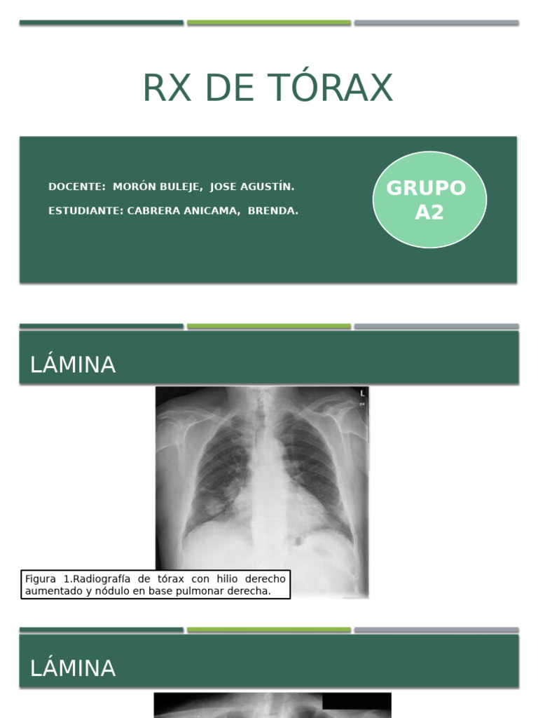 Rx de tórax 2 | PDF