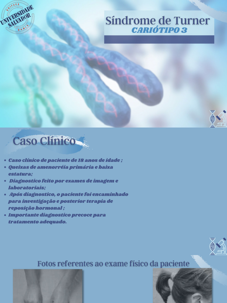 Síndrome de Turner- Slide | PDF | Doenças e distúrbios | Especialidades ...