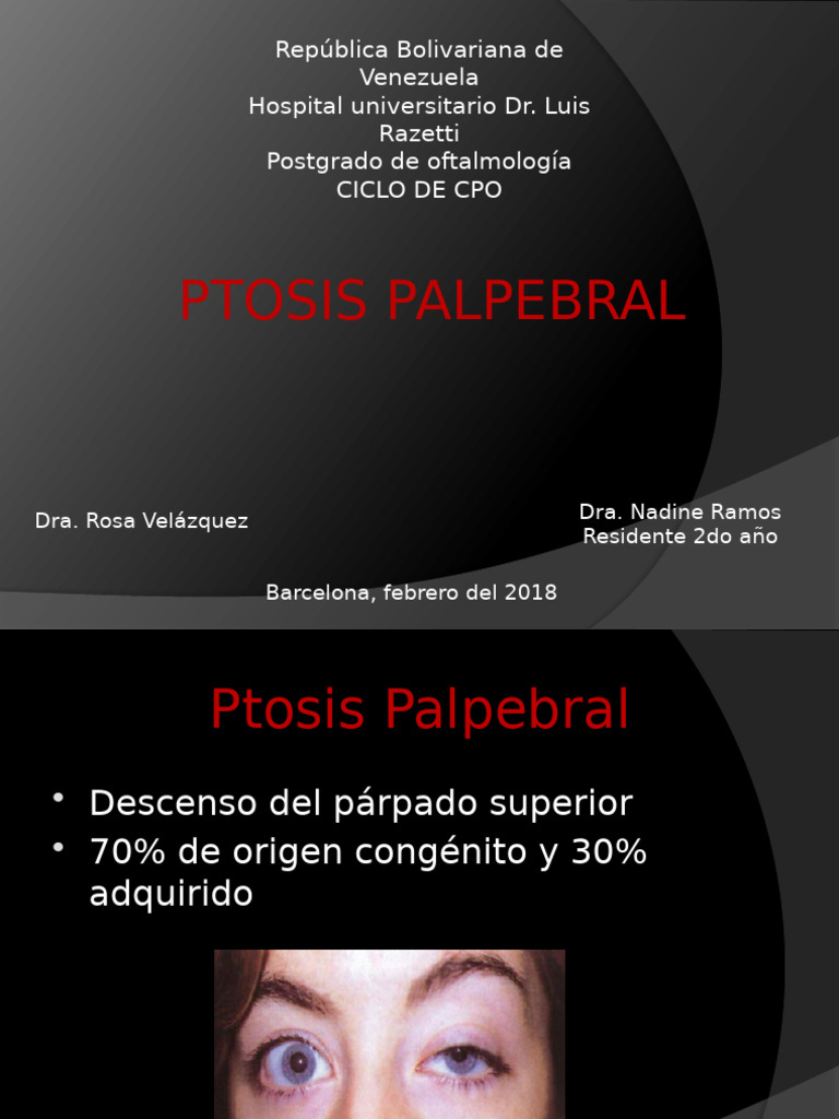 Ptosis Palpebral NADINE | PDF | Medicina CLINICA | Especialidades Medicas