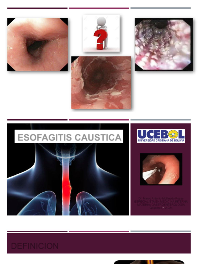 Esófago y Complicaciones por Sustancias Cáusticas | PDF ...