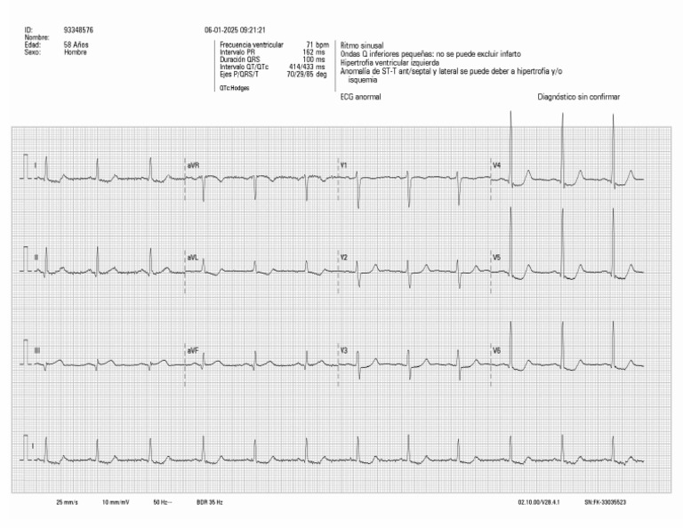 Ekg 2 | PDF