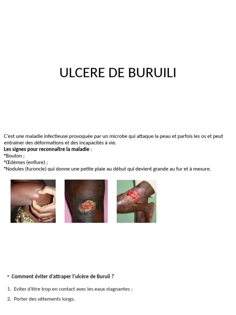 Ulcere de Buruli | PDF