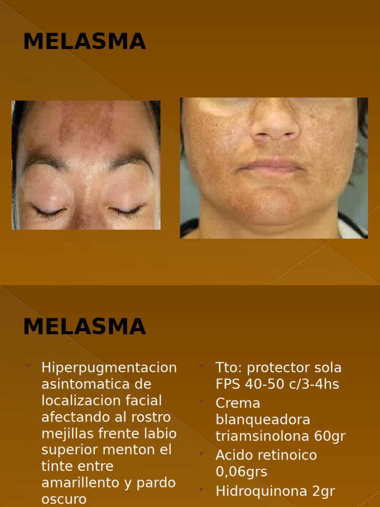 MELASMA | PDF | Psoriasis | Piel