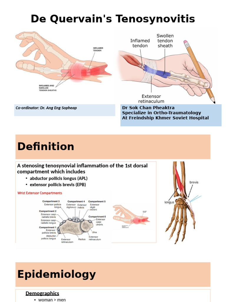 De Quervain's Tenosynovitis Overview | PDF | Thumb | Hand