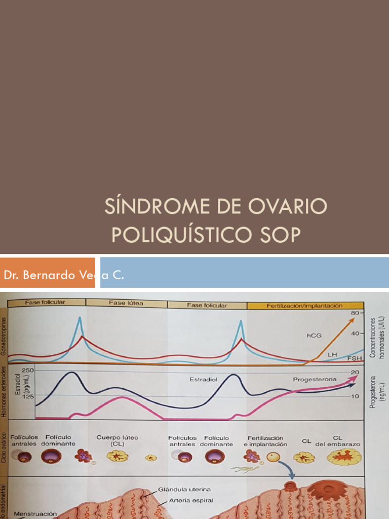 Síndrome de Ovario Poliquístico: Diagnóstico y Tratamiento | PDF ...