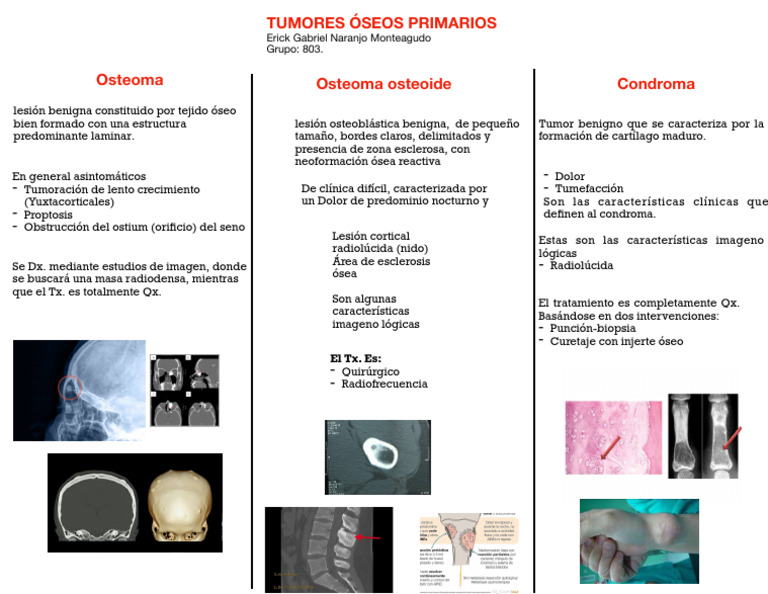 Osteoma Osteoma Osteoide Condroma: Erick Gabriel Naranjo Monteagudo ...