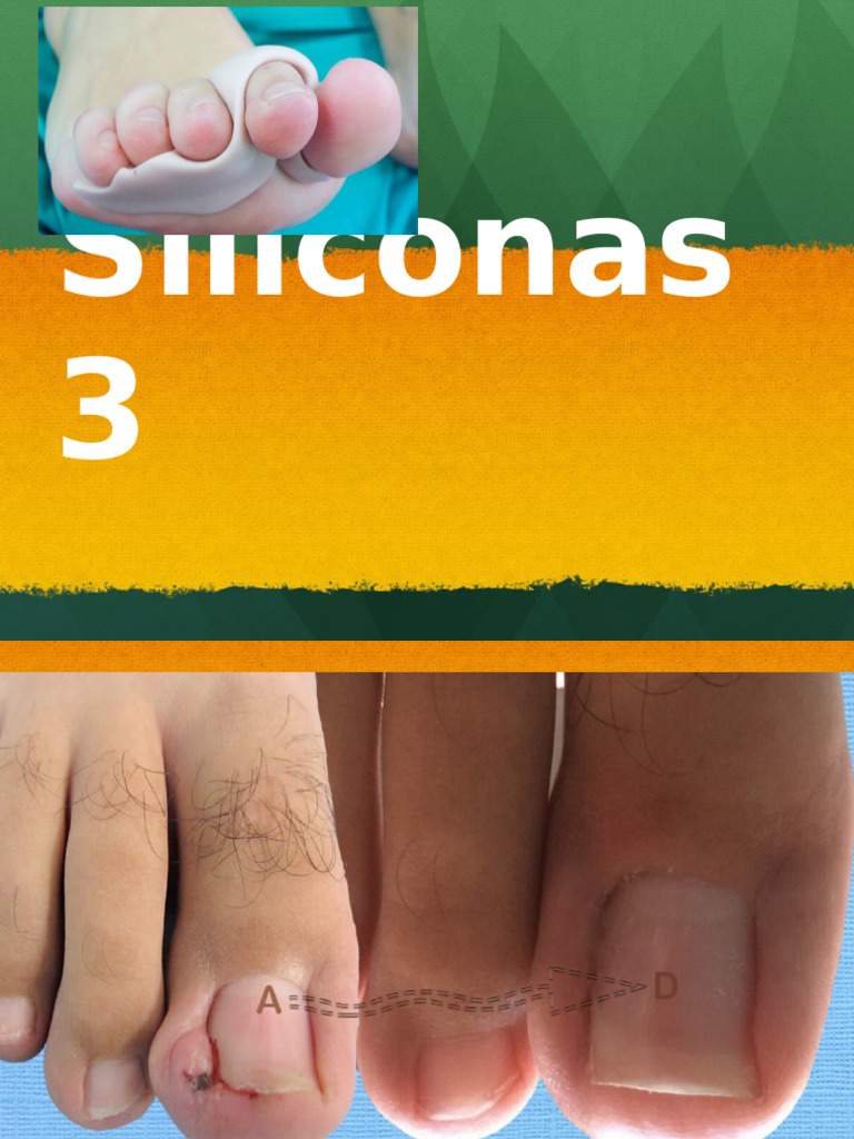 Tipos y Uso de Siliconas en Podología | PDF