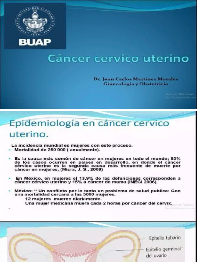 Cancer Cervicouterino | PDF