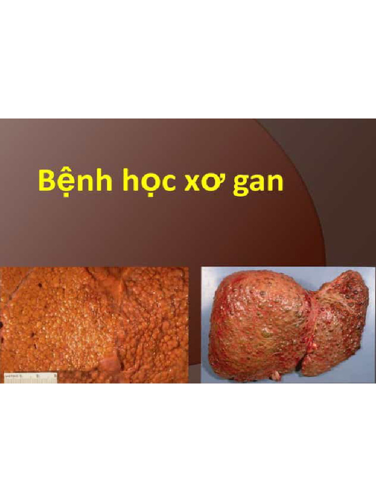 bệnh học xơ gan | PDF
