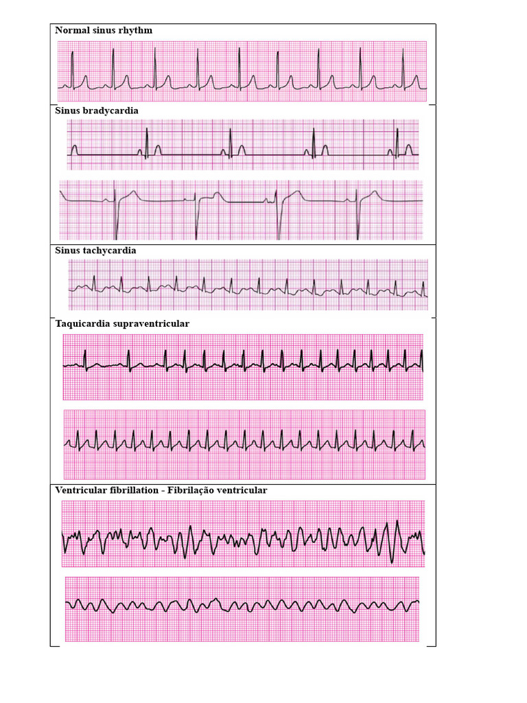 ACLS - Ritmos Cardíacos - Questões para Revisar | PDF | Reanimação ...