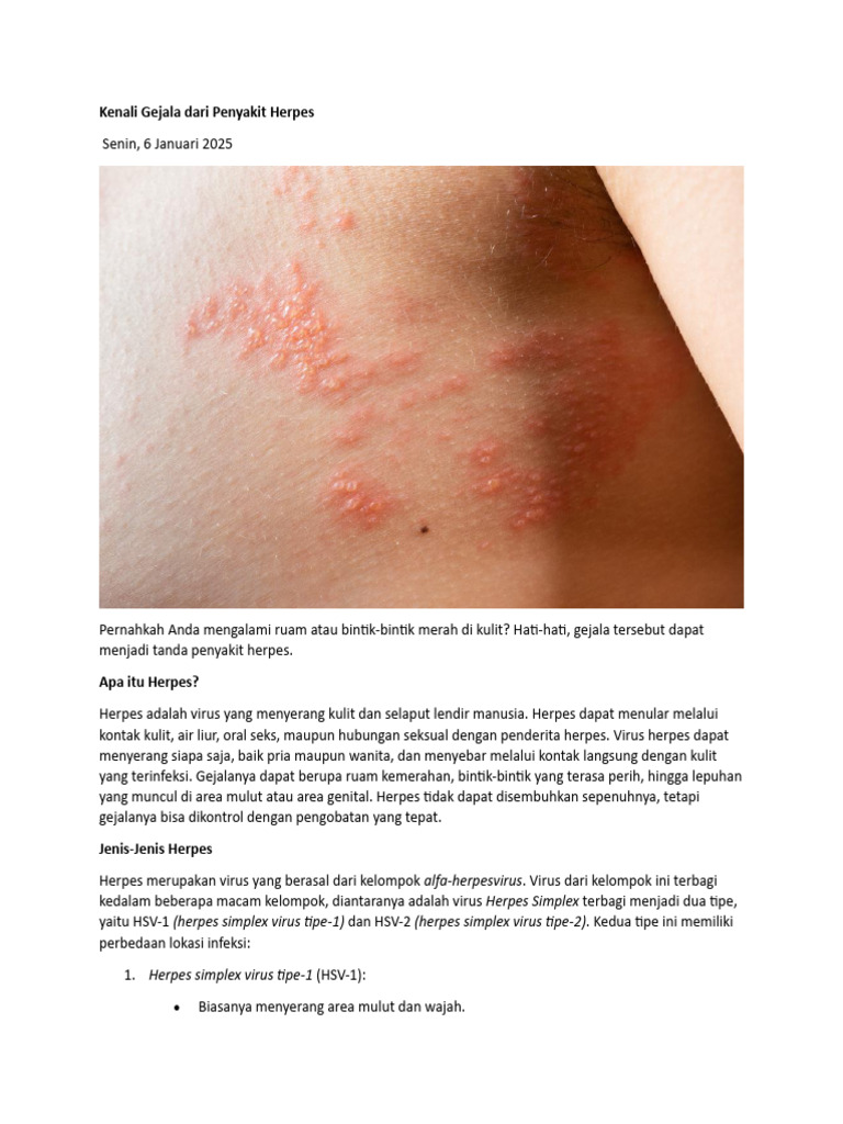 Kenali Gejala Dari Penyakit Herpes | PDF