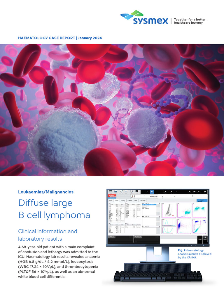 SEU B Cell Lymphoma Case Report en View | PDF | Lymphocyte | White ...