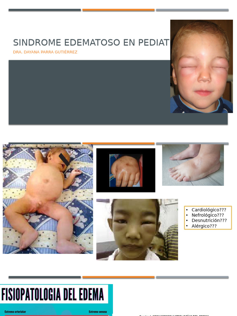 Sx Edematoso Enj Pediatria | PDF