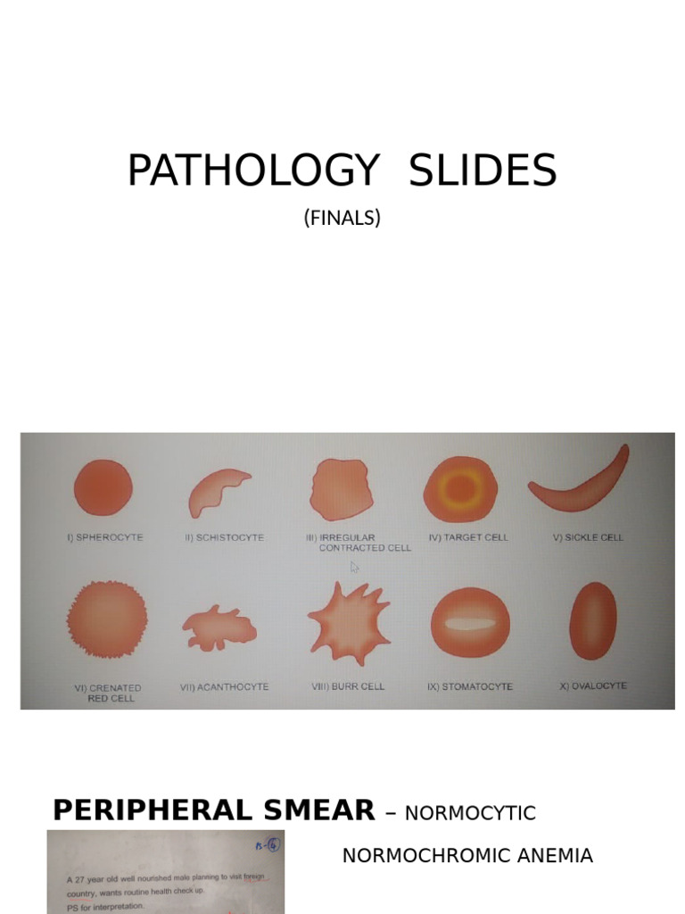 Pathology Slides: Anemia & Leukemia Types | PDF | Anemia | Epithelium