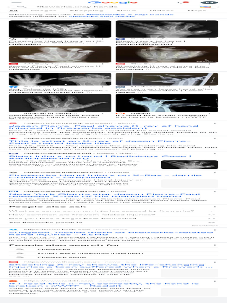 Firework Hand Injury X-Rays Explained | PDF | X Ray | Clinical Medicine