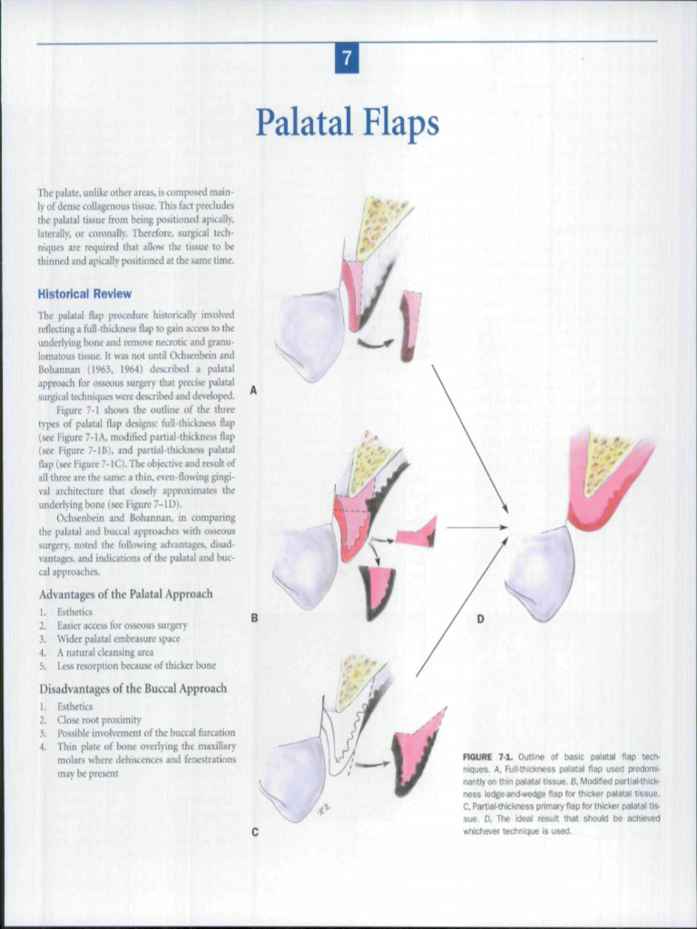 Palatal Flaps | PDF | Medical Specialties
