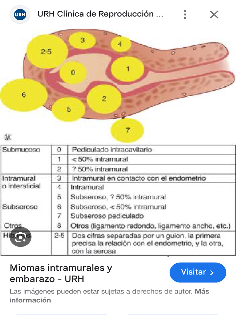 Clasificacion de La Figo Miomas - Buscar Con Google | PDF