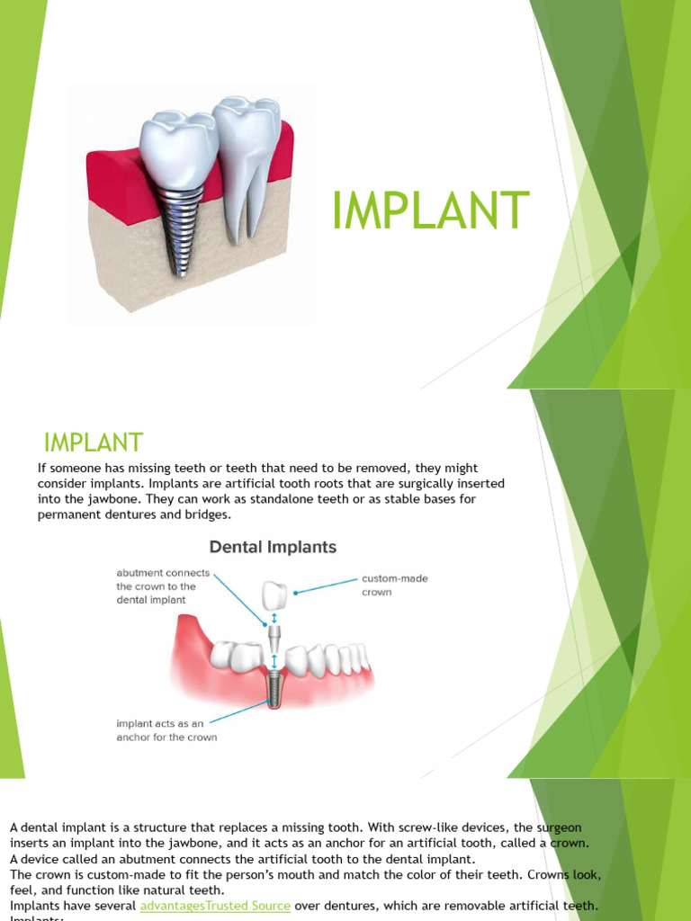 Dental Implants: Types and Benefits | PDF | Dental Implant | Dentures