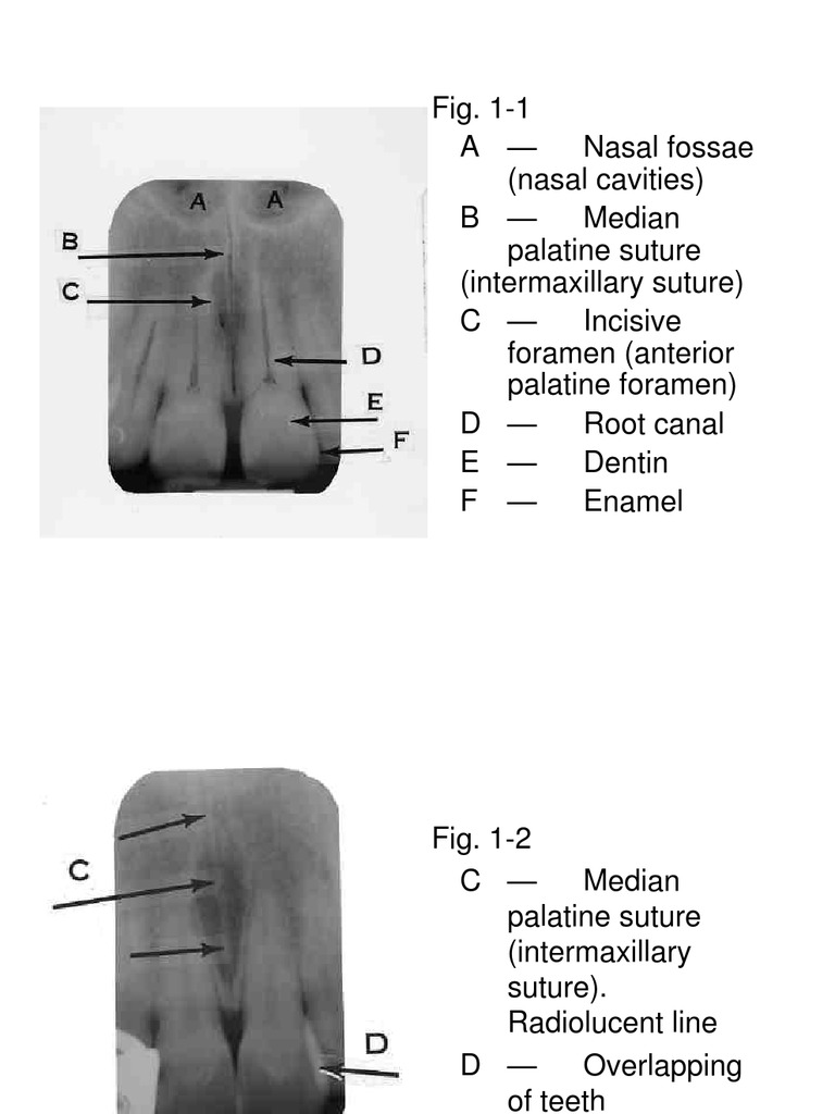 Normal Radiographic Dental Anatomy | PDF | Mouth | Human Anatomy