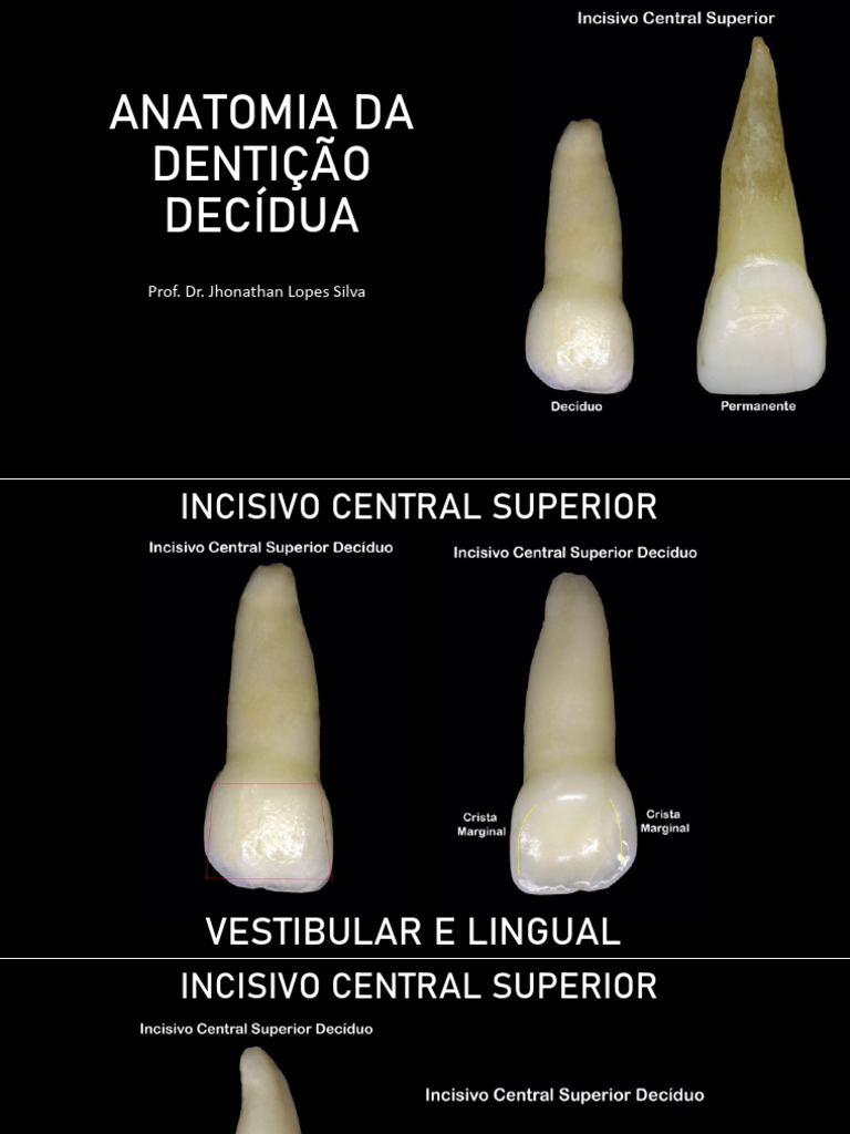 Anatomia Da Dentição Decídua | PDF