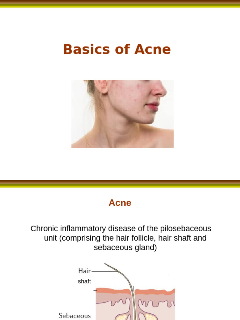 Basics of Acne Modified | PDF | Clinical Medicine | Dermatology
