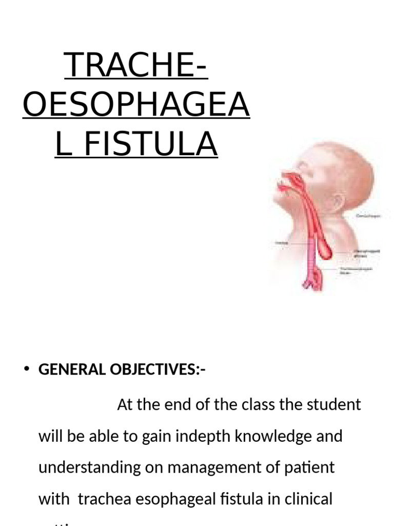 Tracheoesophageal Fistula Management Guide | PDF | Esophagus | Dehydration