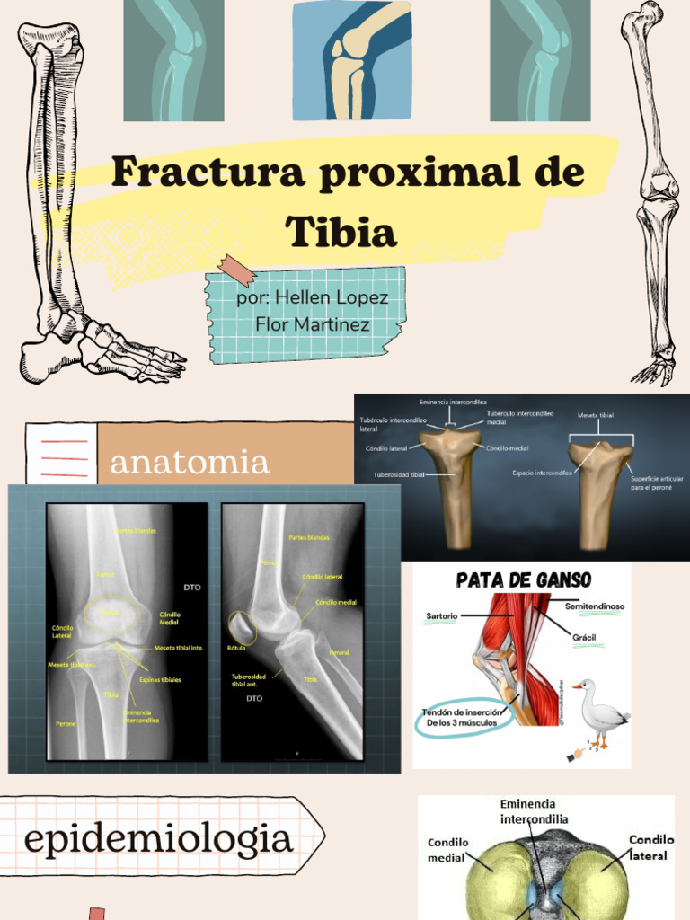 Fractura Proximal de Tibia: Clasificación y Tratamiento | PDF | Rodilla ...
