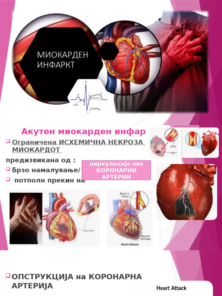 Akuten Miokarden Infarkt | PDF
