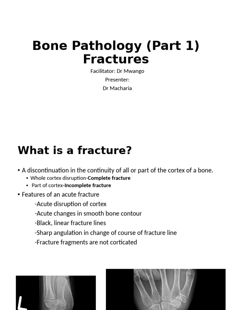 Fractures Presentation Undergraduate Class 30-11-18 | PDF | Bone ...