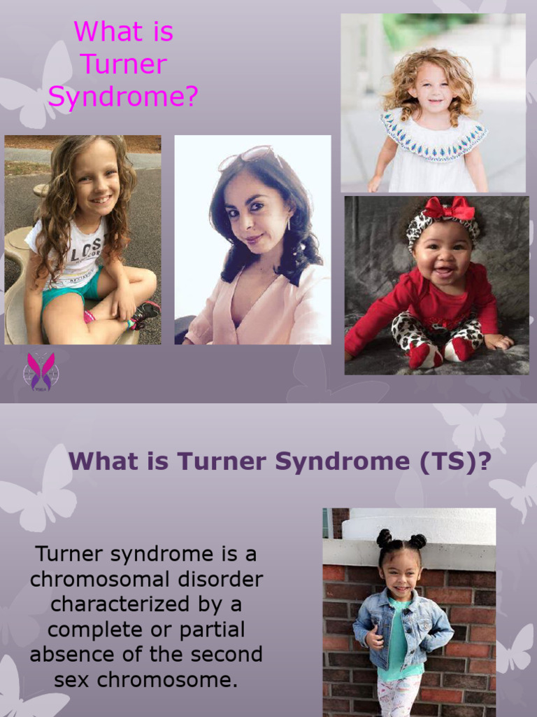 What Is Turner Syndrome | PDF | Diseases And Disorders | Causes Of Death