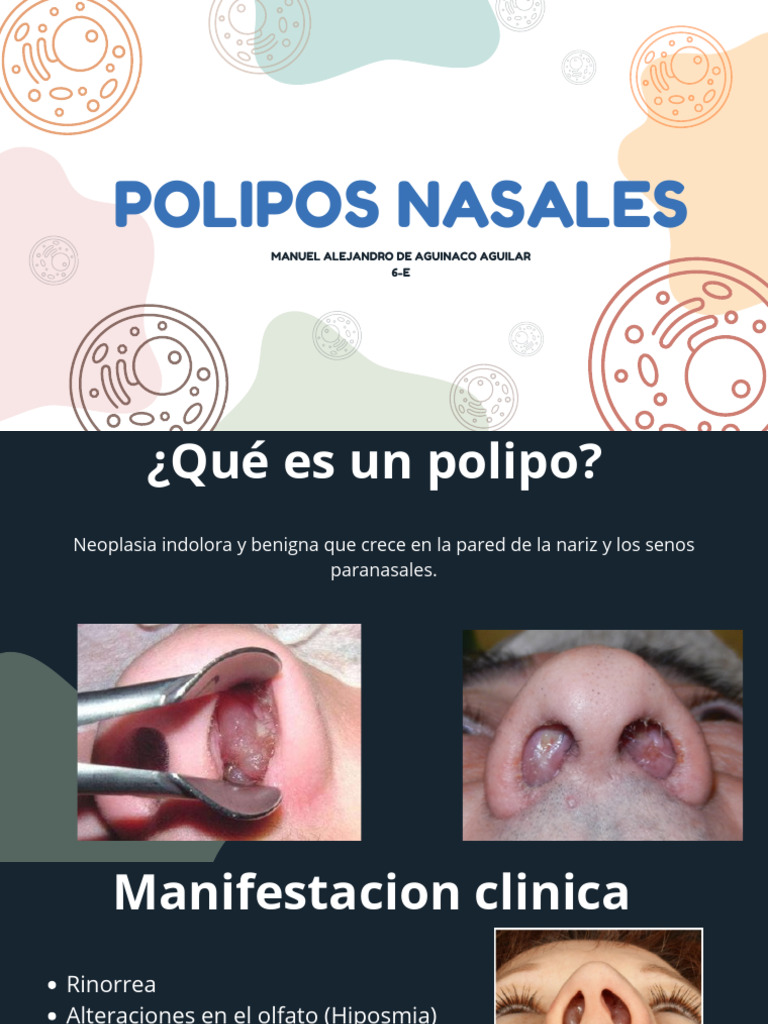 Polipos Nasales: Síntomas y Tratamiento | PDF