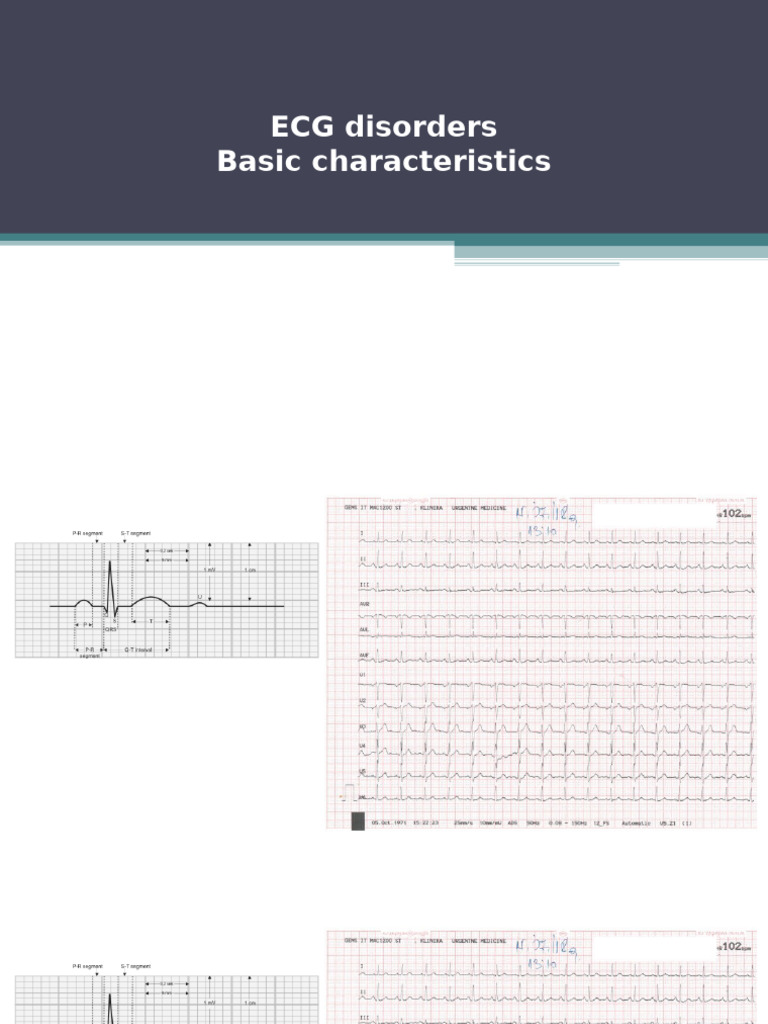 ECG Disorders Lecture | PDF | Electrocardiography | Myocardial Infarction