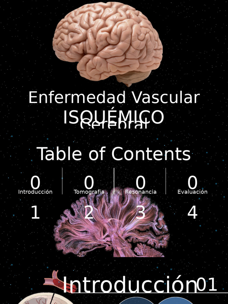EVC Isquemico (Autoguardado) | PDF