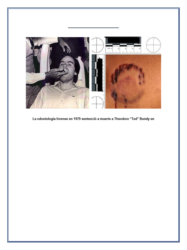 Odontología Forense: Caso Ted Bundy | PDF