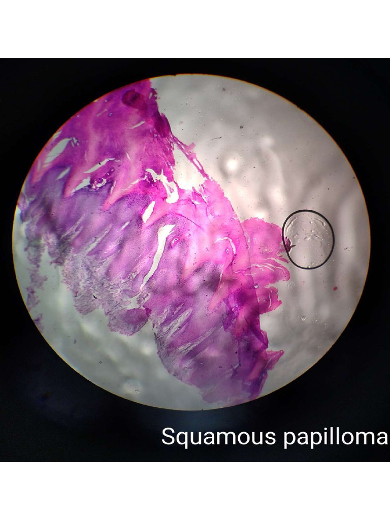 Pathology Practical 6 Neoplasia | PDF