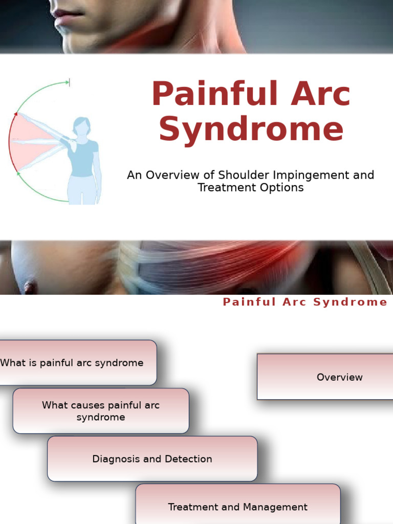 Understanding Painful Arc Syndrome | PDF | Shoulder | Medical Specialties