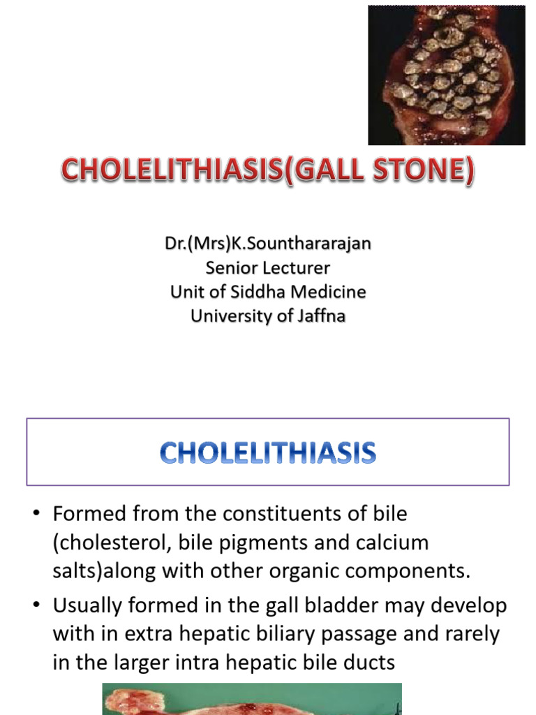 Cholelithiasis Gall Stone | PDF | Bile | Gallbladder